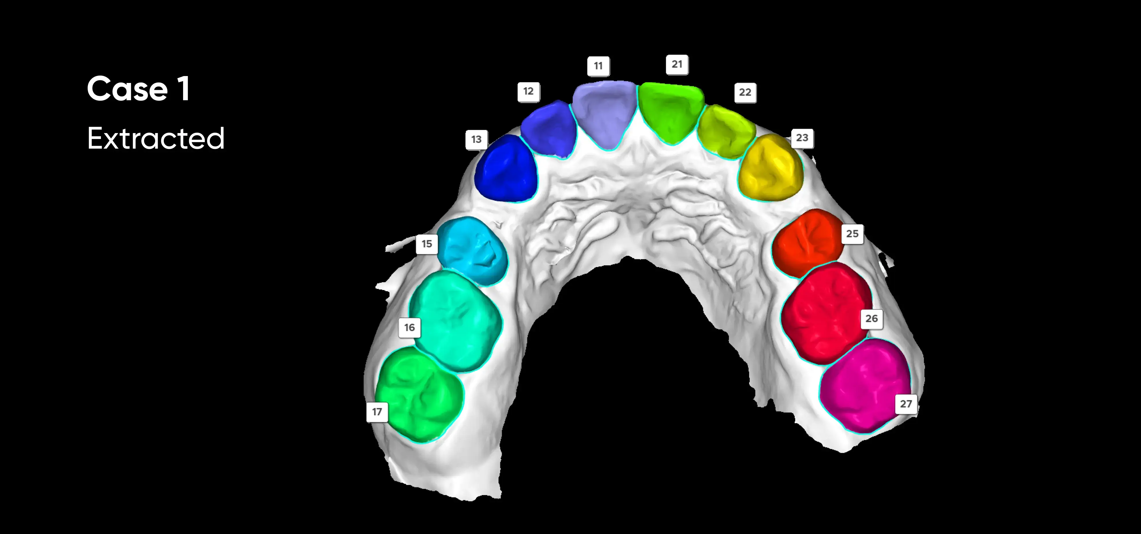 Case 1 upper teeth scan with every tooth in different color and number ...