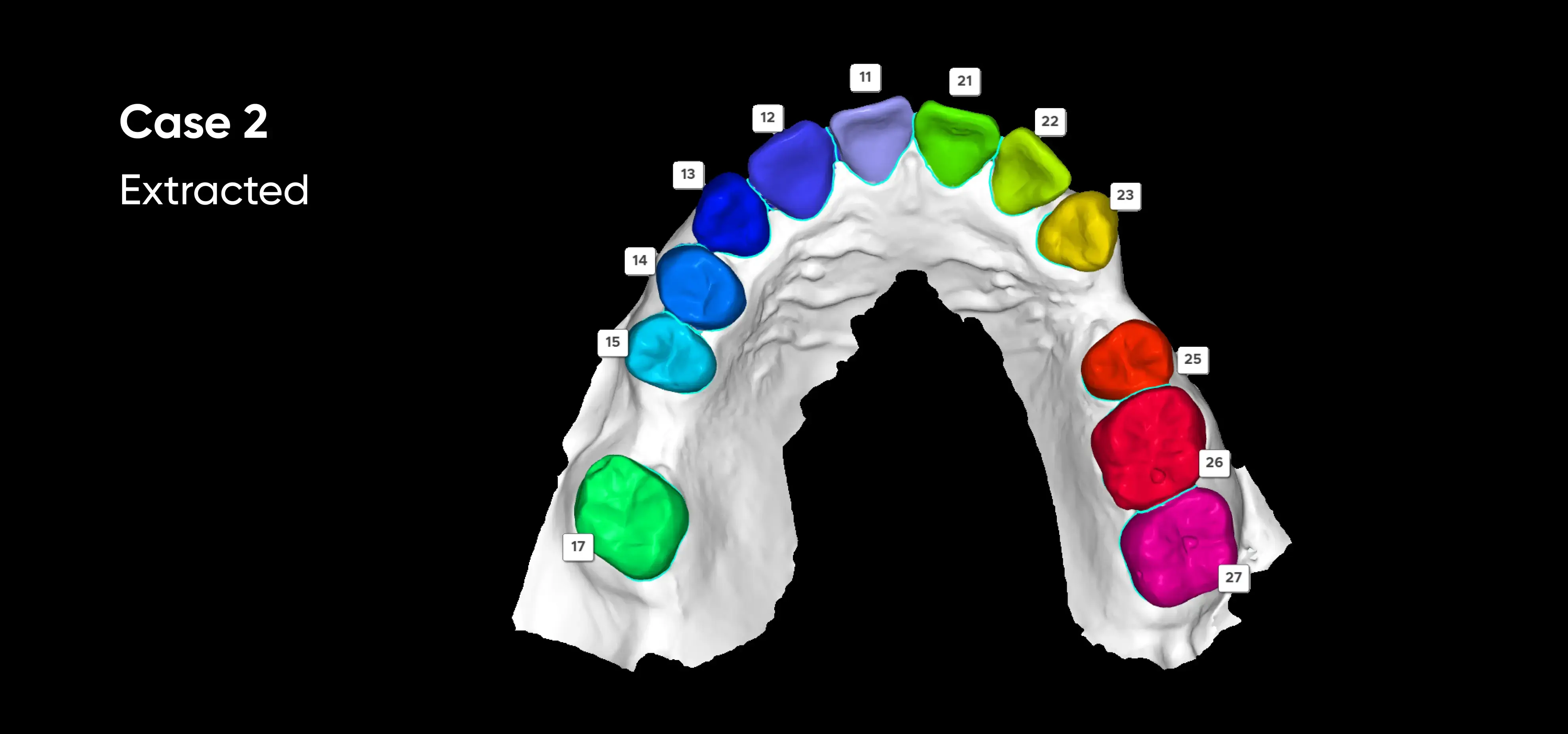 Case 2 upper teeth scan with every tooth in different color and number; one missing tooth on ...